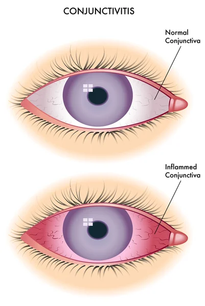 Vectores De Stock De Conjuntivitis Ilustraciones De Conjuntivitis Sin