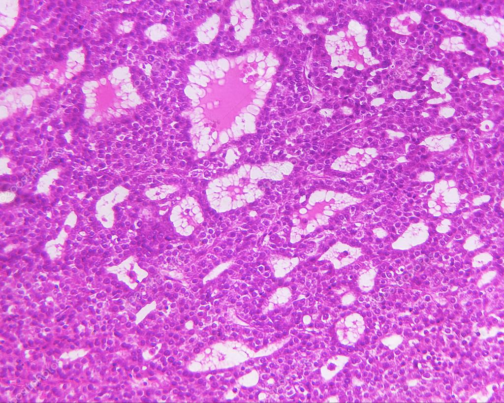 Hepatocellular carcinoma of a human Stock Photo by ©bond80 76178073