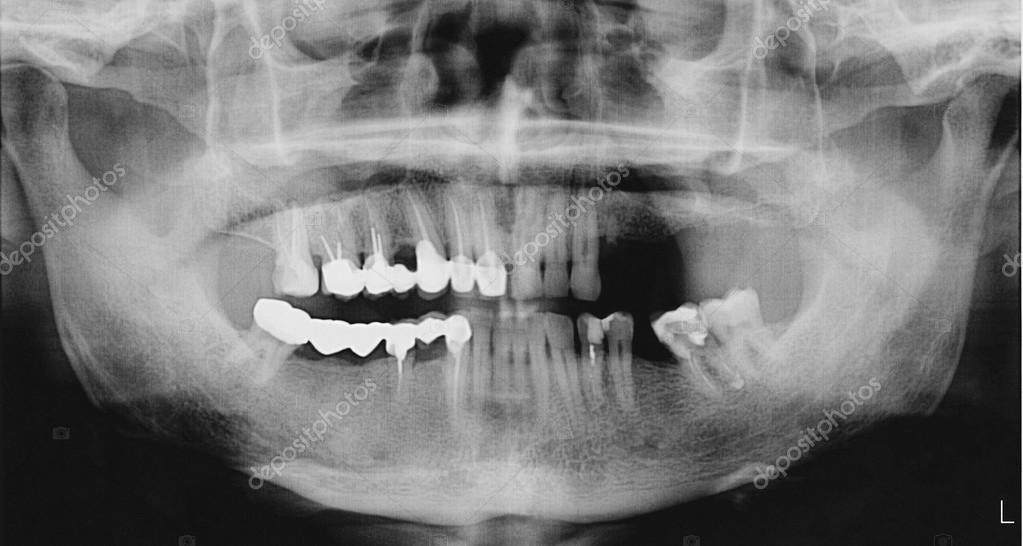 Panoramic x-ray of the mouth — Stock Photo © rihardzz #71671569