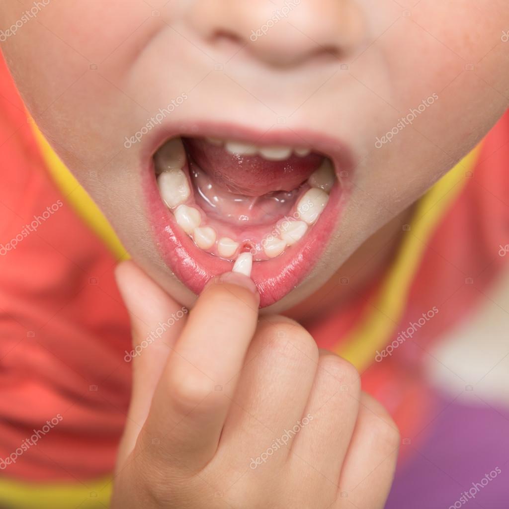 Tooth Fell Out The Child Tooth Fell Out. Selective Focus. Kid.