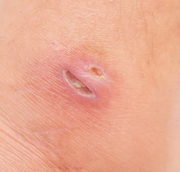 Wound healing stages Stock Photos, Royalty Free Wound healing stages ...