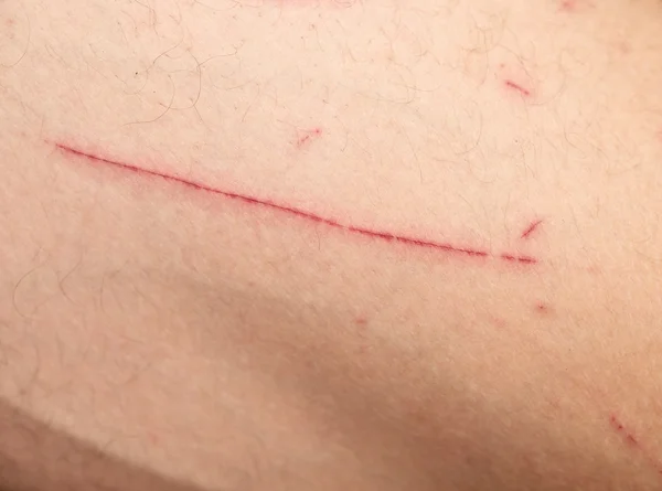 Imágenes de Laceración, fotos de Laceración sin royalties | Depositphotos