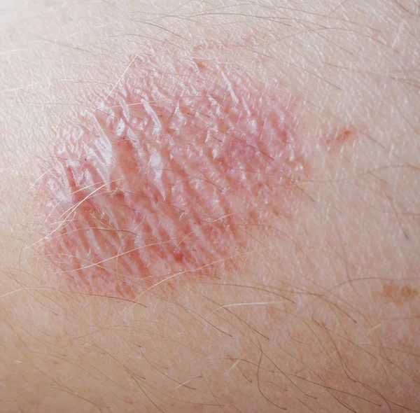 Skin affliction Stock Photos, Royalty Free Skin affliction Images ...