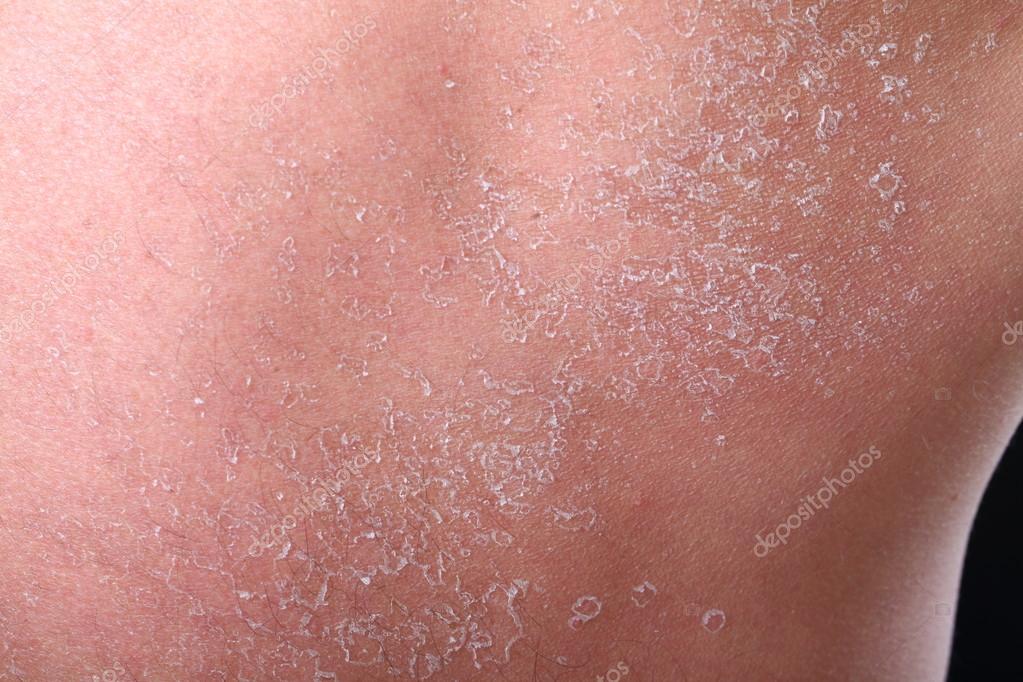 Bad Sunburn Peeling