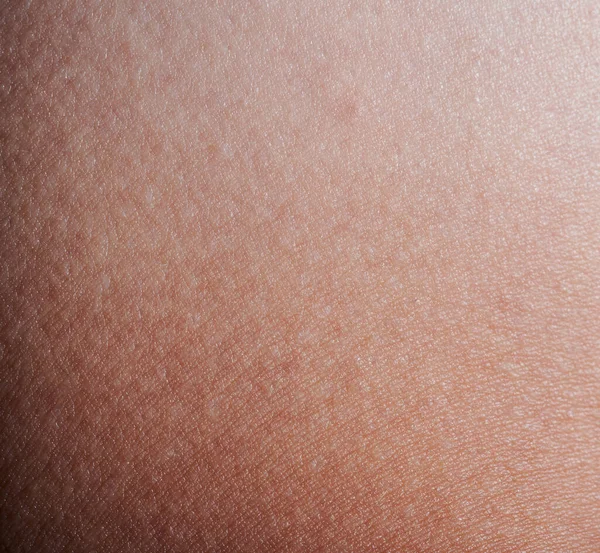 Skin bumps Stock Photos, Royalty Free Skin bumps Images | Depositphotos