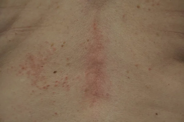 Dermatofagia Stock Photos, Royalty Free Dermatofagia Images | Depositphotos