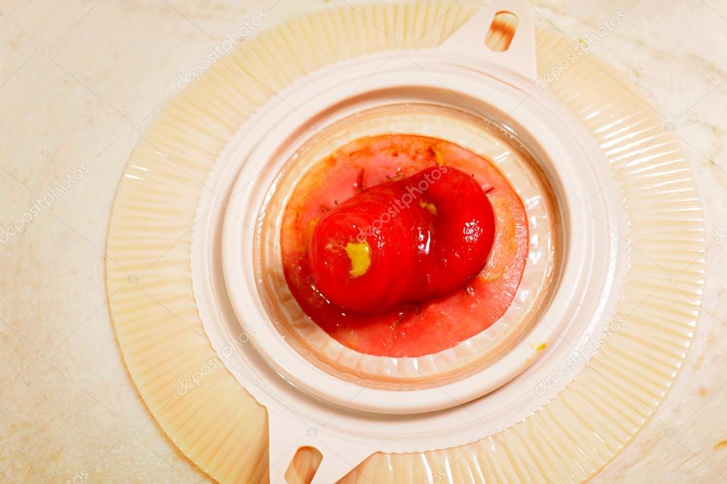 Colostomy — Stock Photo © pajche #71066991