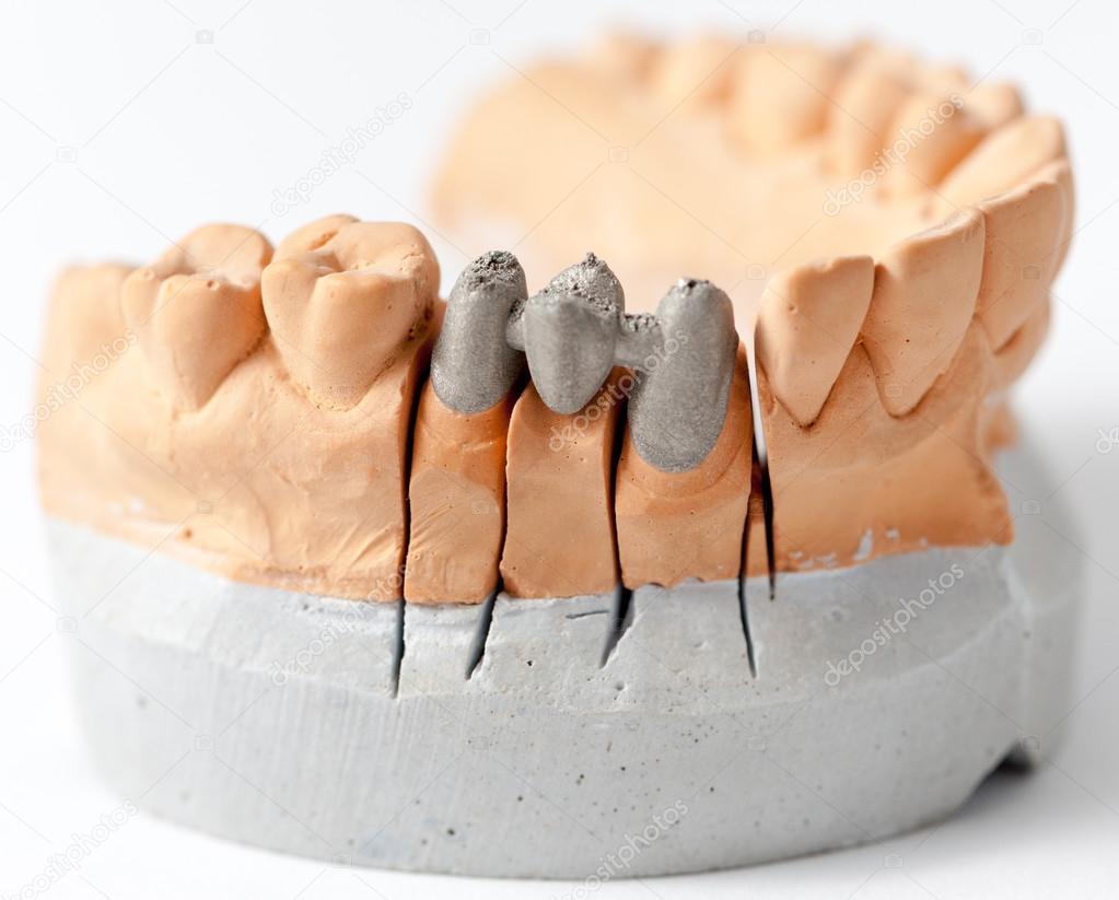 Metal Ceramic Bridge