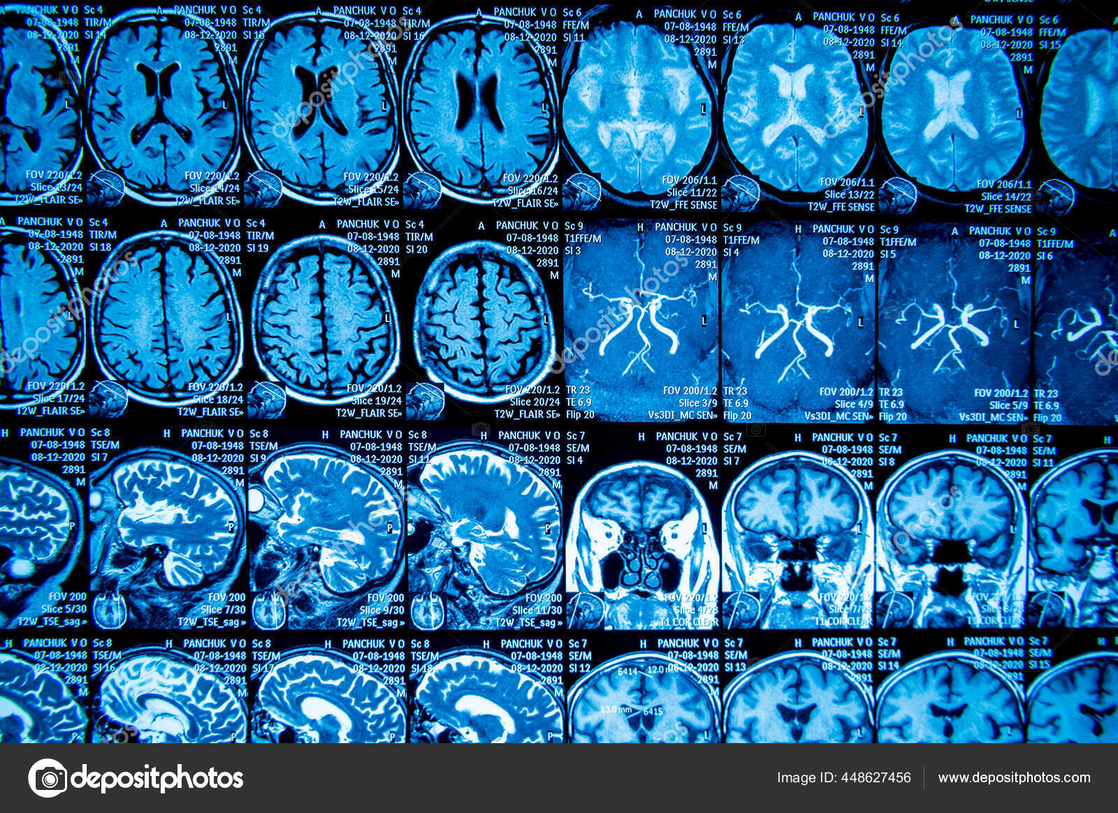 MRI scan of the brain. Magnetic resonance imaging scan Stock Photo by ...