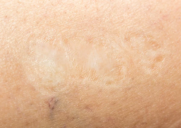 Skin affliction Stock Photos, Royalty Free Skin affliction Images ...