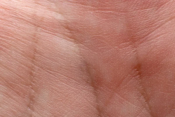 Imágenes de Callosidad cafe en la piel grietas, fotos de Callosidad ...