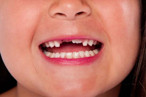 Child missing teeth Pictures, Child missing teeth Stock Photos & Images ...