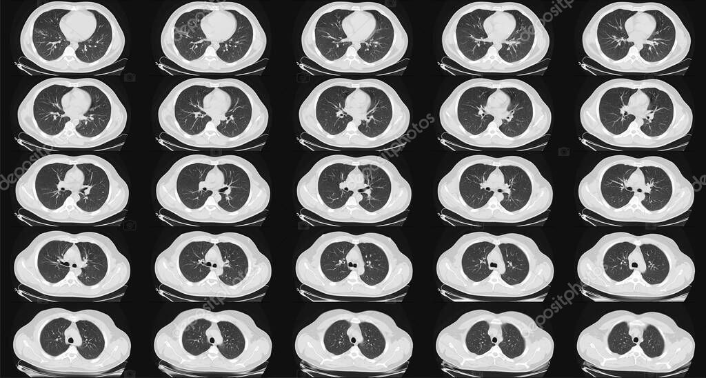 Tomografía computarizada de los pulmones en un hombre adulto sano. TAC ...