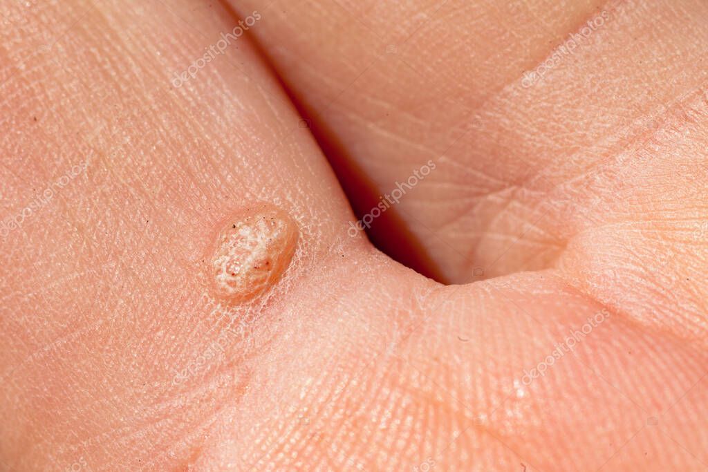 Verruga común, Verruca vulgaris, en el dedo de la mano humana caucásica ...