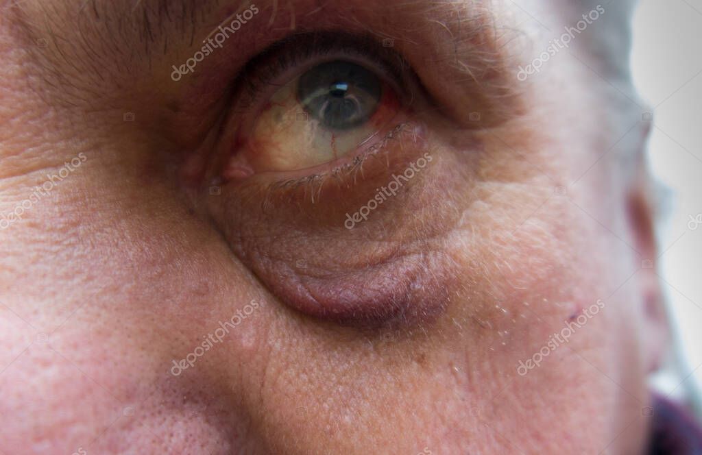 hematoma en la zona ocular tres días después del accidente con un golpe ...