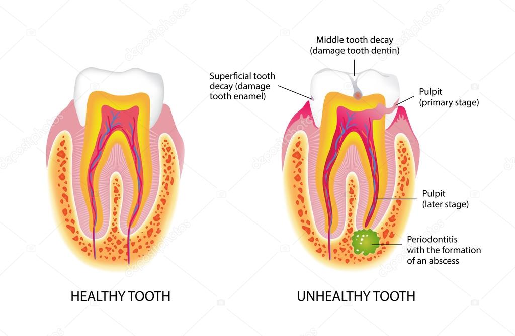 Healthy and unhealthy tooth — Stock Photo © svetik #90674858