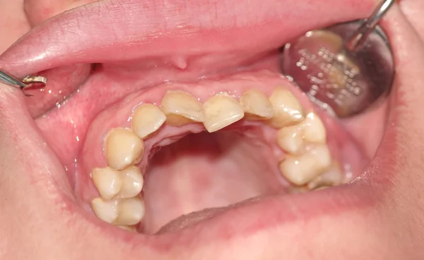 Malocclusion Stock Photos, Royalty Free Malocclusion Images | Depositphotos