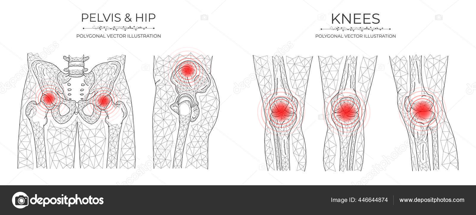 Illustration Vectorielle Polygonale Des Douleurs Pelviennes ...