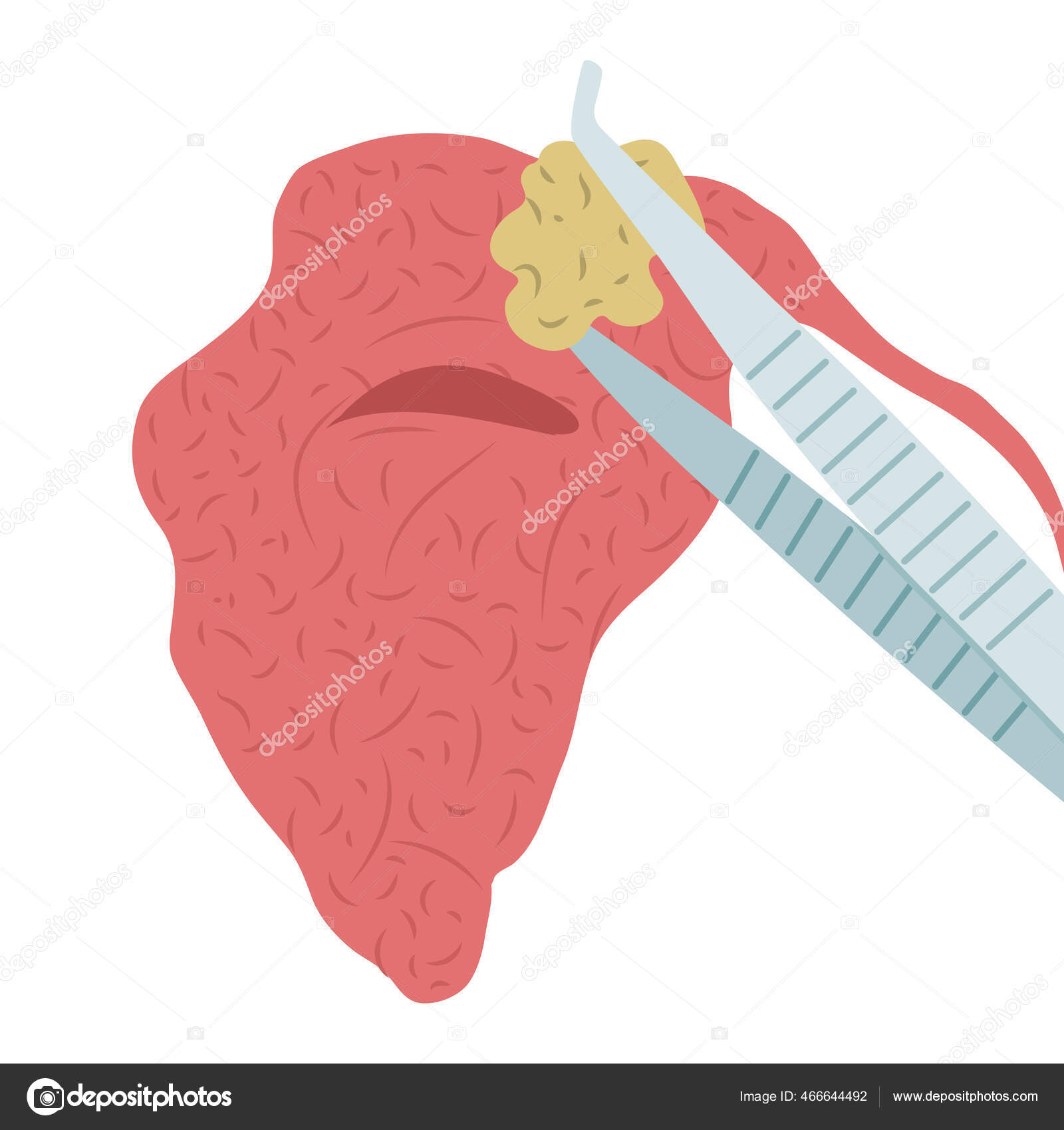 Vector Illustration Removing Stone Parotid Salivary Gland ...