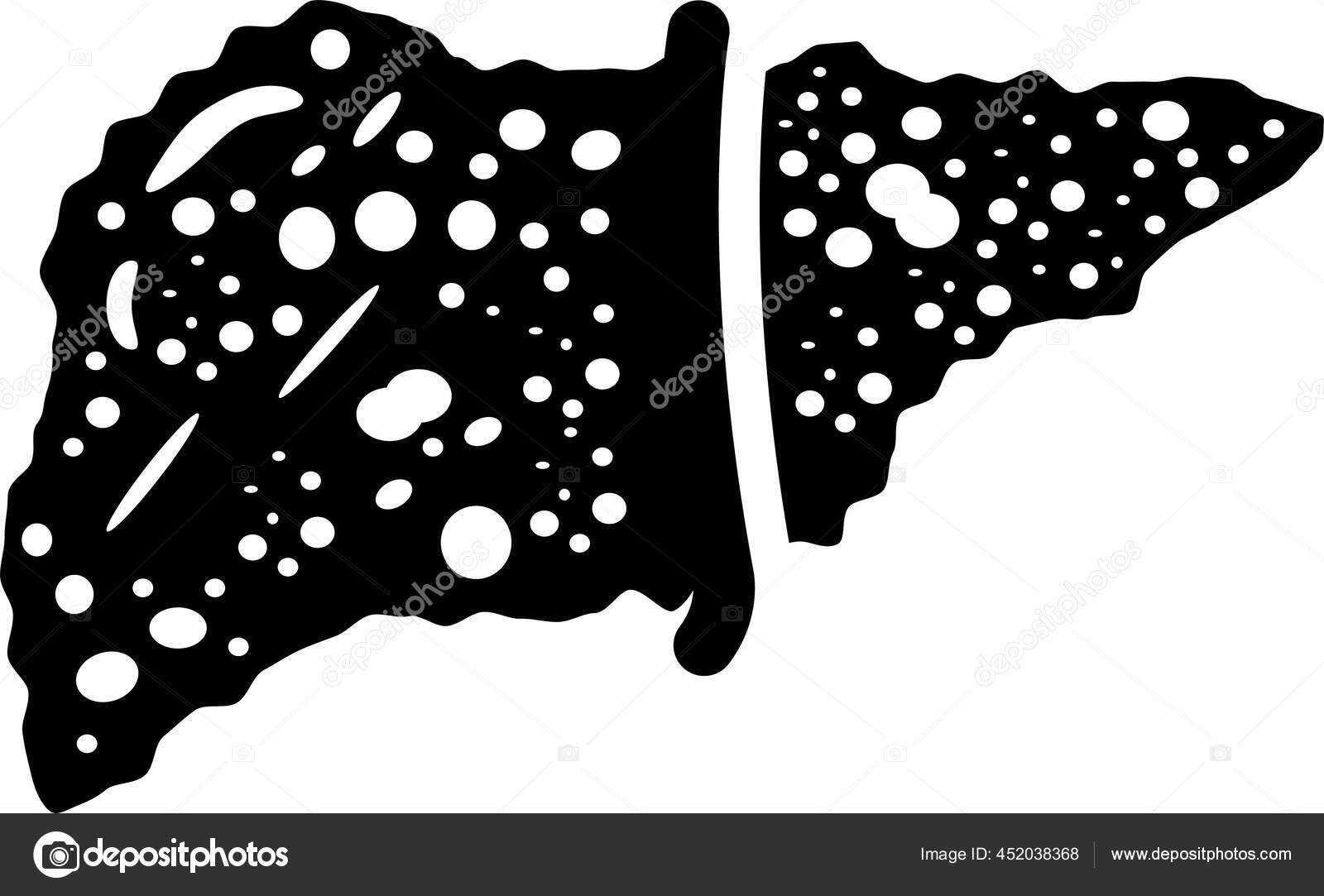 Liver Cancer Symptoms Causes Risk Factors Diagnosis Stick Figure ...