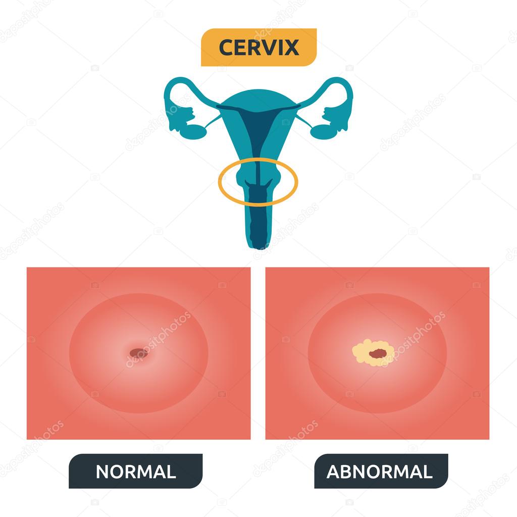 Cervix Stock Vector Image by ©nongpimmy #81741316
