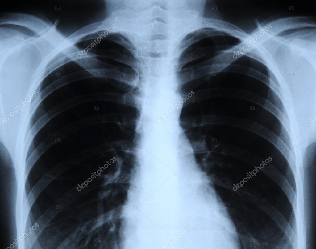 Radiograph of human chest Stock Photo by ©fotokon 63687929