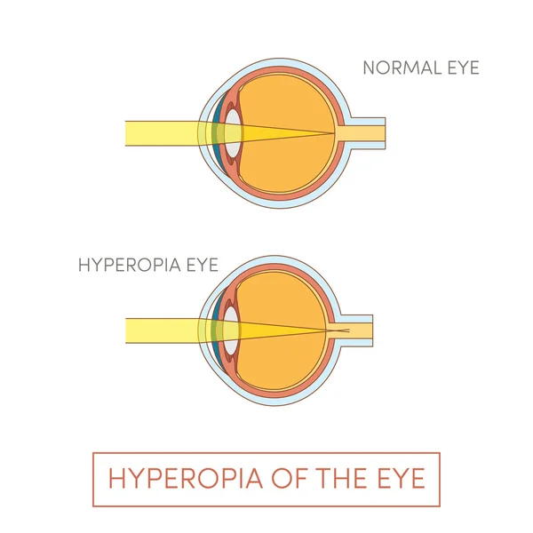 Vision Defects - Myopia, Hyperopia And Astigmatism — Stock Vector ...
