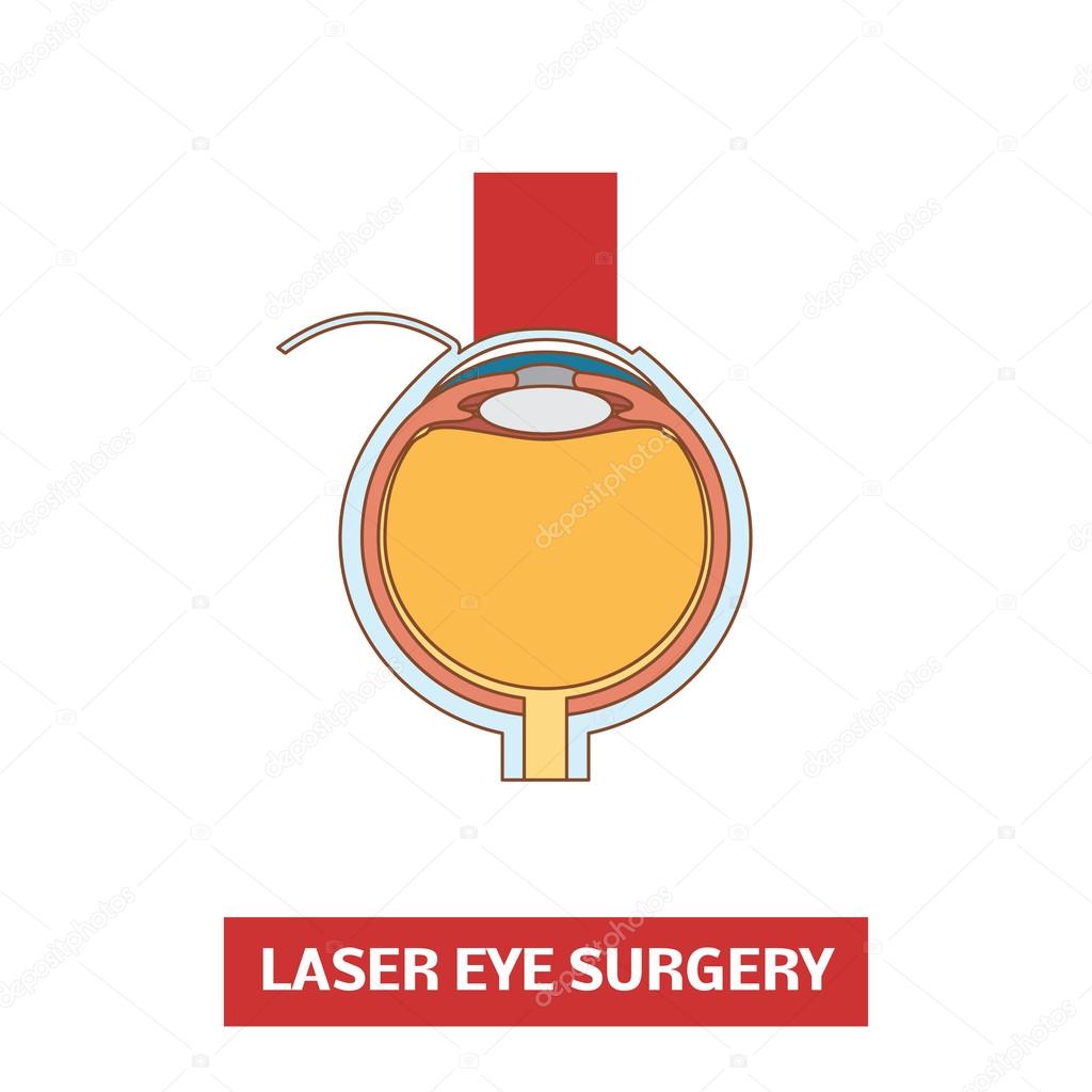 Laser eye surgery Stock Vector by ©marina_ua 118639454