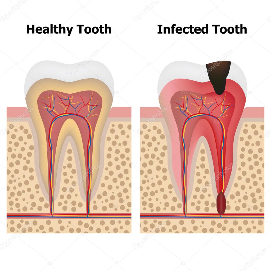 Pulpitis and Healthy tooth Stock Vector Image by ©Neokryuger #102889270