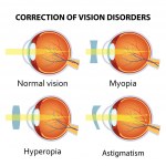 Vision Defects - Myopia, Hyperopia And Astigmatism — Stock Vector ...