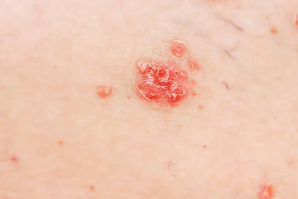Allergic rash dermatitis skin — Stock Photo © panxunbin #6926399