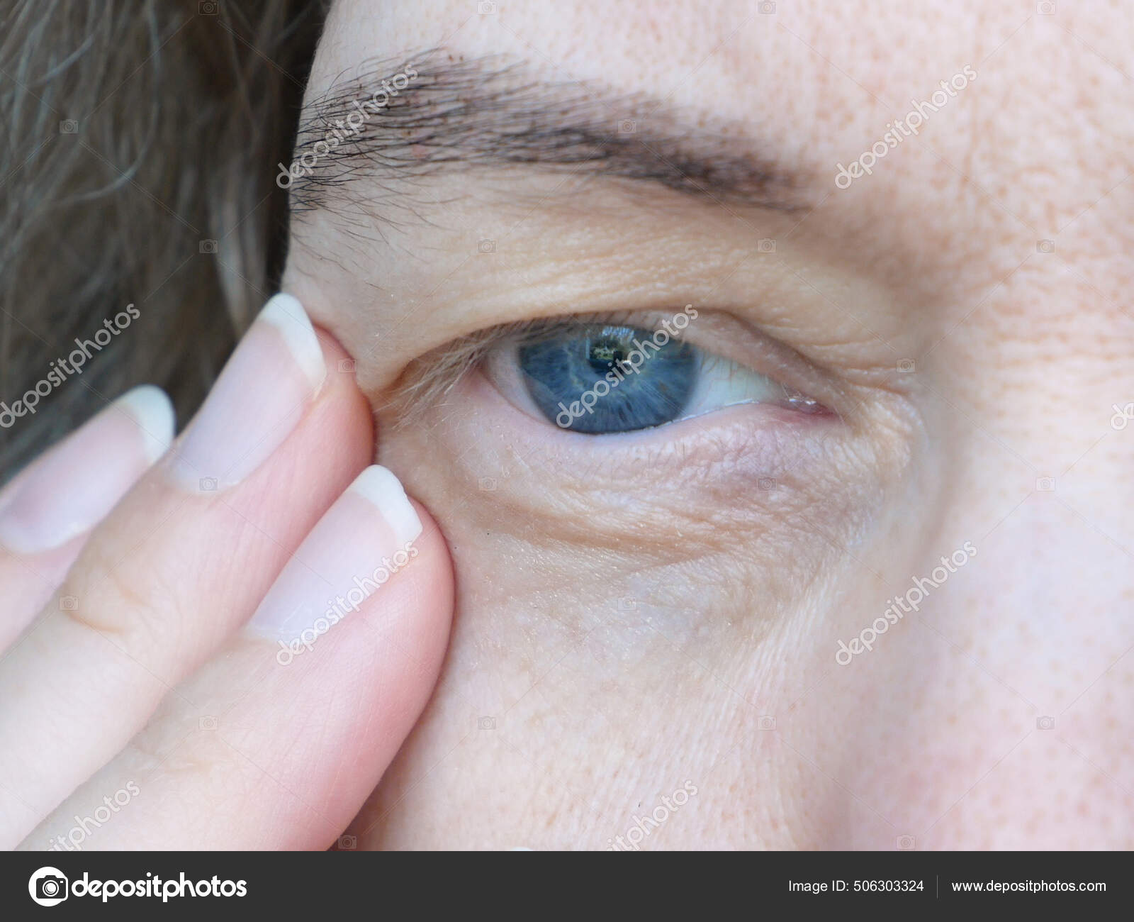 Middle Aged Female's Eye Drooping Eyelid Ptosis Drooping Upper Eyelid ...