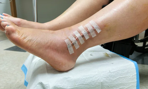 Woman's Leg after staple removal post surgery to repair a fractu ...