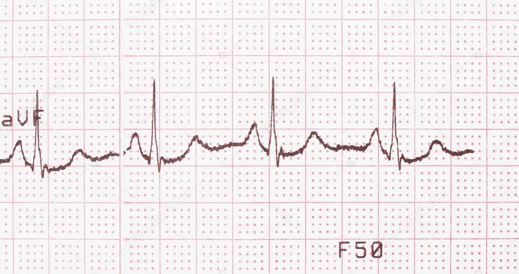 Ekg Print Out