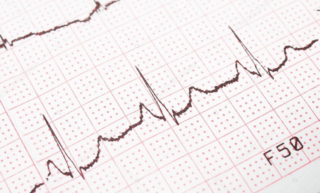 Eletrocardiograma, impressão de Ecg, fundo de ECG — Stock Photo ...