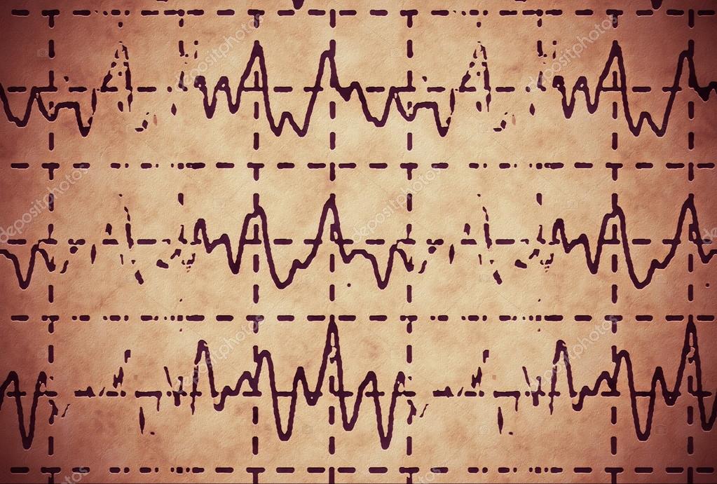 Brain wave on electroencephalogram EEG for epilepsy, illustration ...