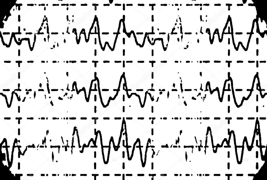 Brain wave on electroencephalogram EEG for epilepsy, illustration ...