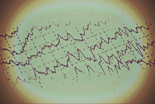Brain wave on electroencephalogram EEG for epilepsy, illustration ...