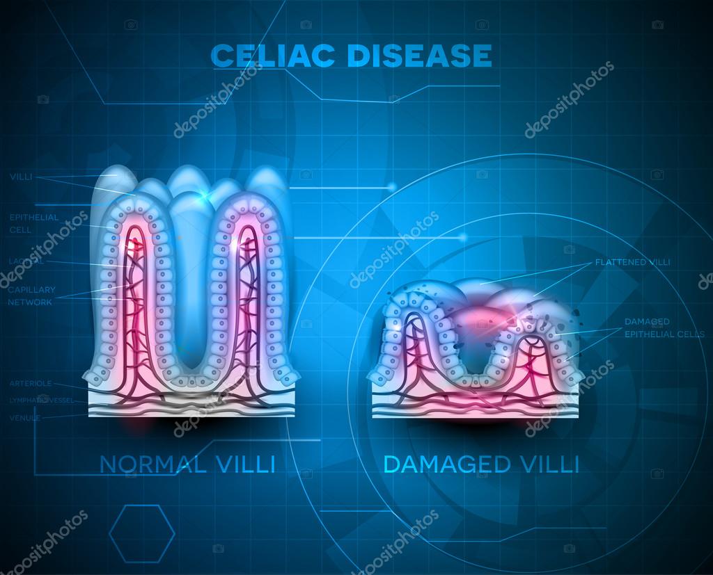 Healthy small intestine villi and unhealthy villi affected by Celiac ...