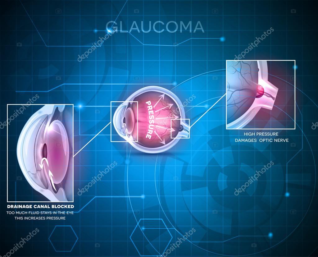 Glaucoma blue background Stock Vector Image by ©megija #106170646
