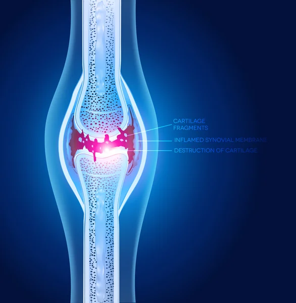 Normal joint anatomy abstract blue design Stock Vector Image by ©megija ...
