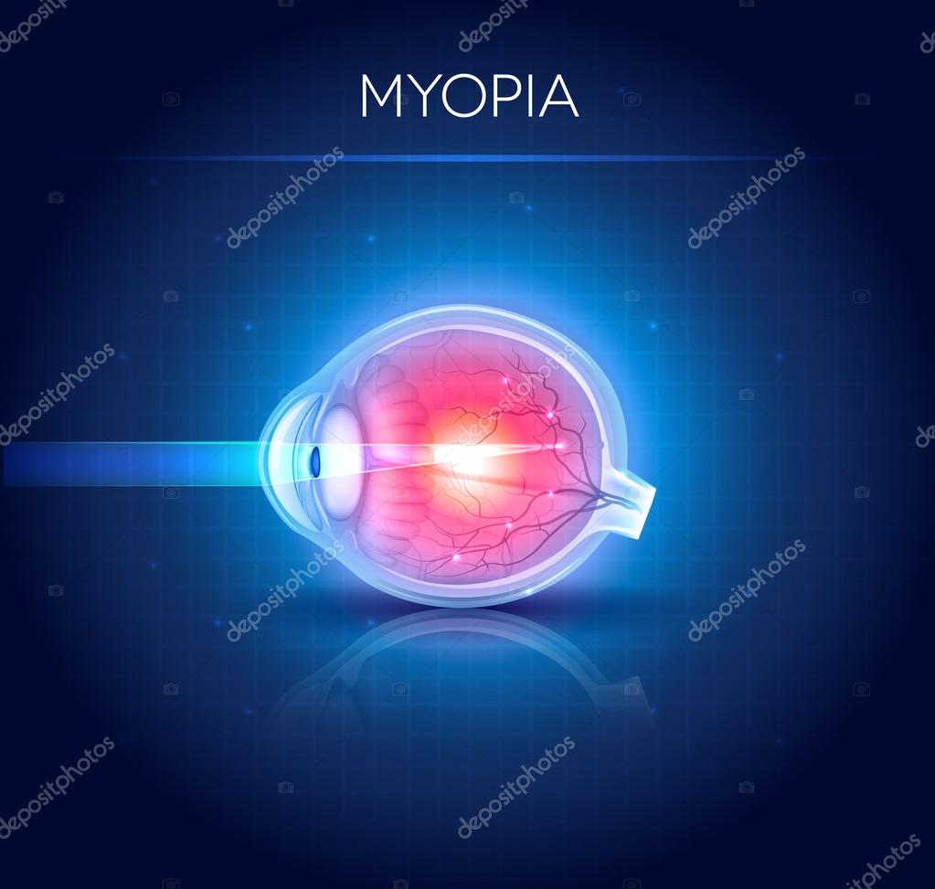 Myopia eyesight disorder Stock Vector Image by ©megija #65674599