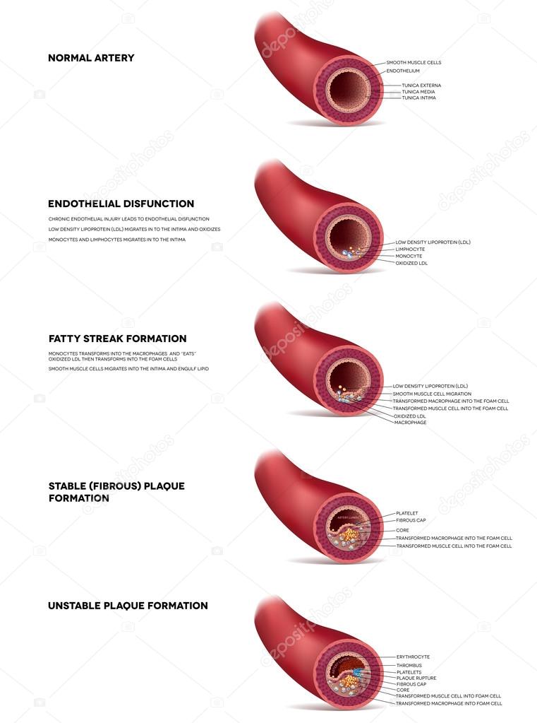 Atherosclerosis Plaque Formation Steps