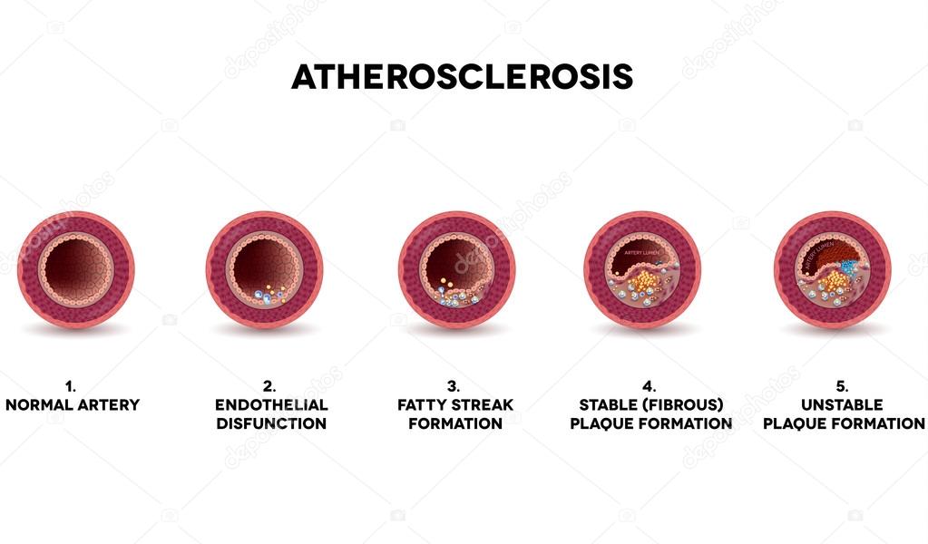 Atherosclerosis formation Stock Vector by ©megija 68556265
