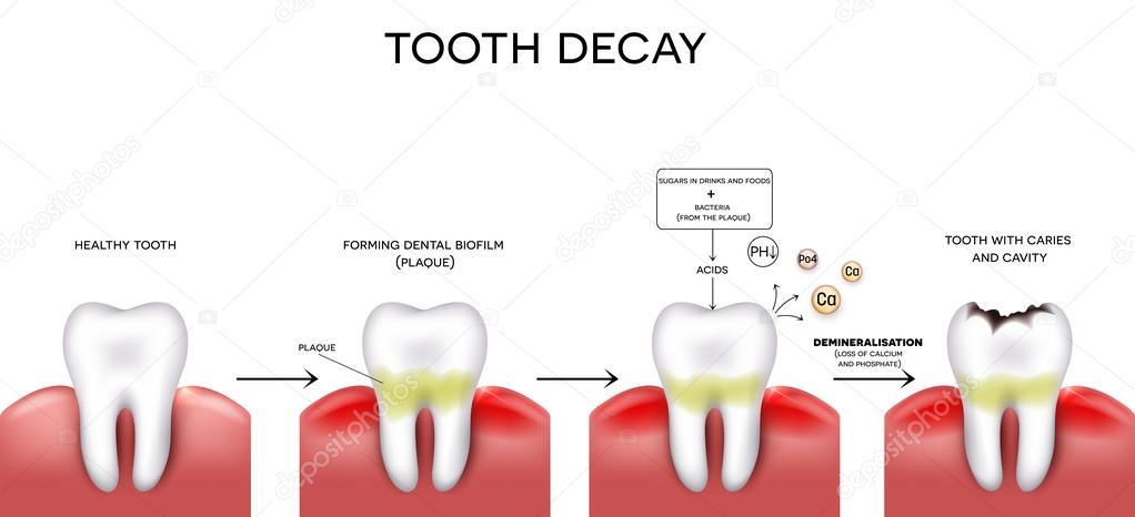 Tooth decay formation Stock Vector Image by ©megija #85987262
