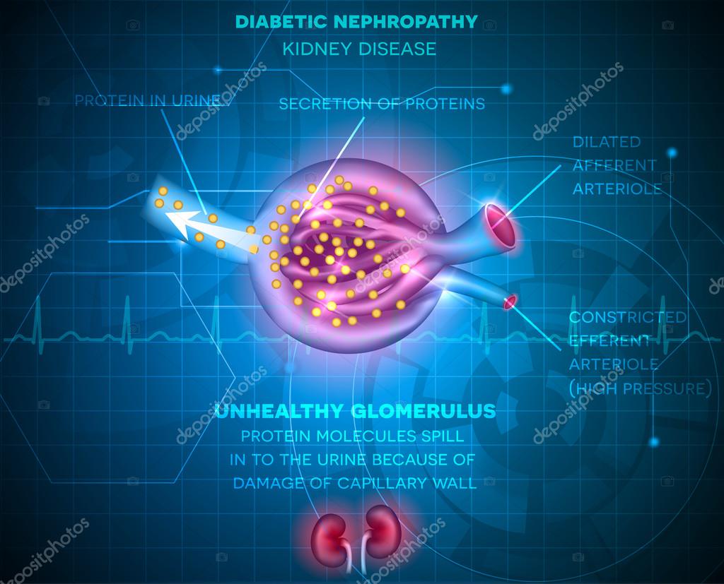 Nefropatía diabética, enfermedad renal 2024