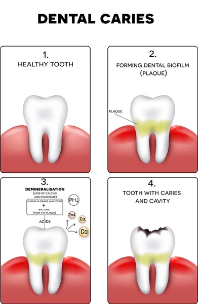 Tooth Decay Dental Caries Formation Detailed Diagram Healthy Tooth Till ...