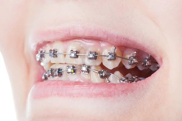 Side view of dental brackets on teeth close up Stock Photo by ©vvoennyy ...