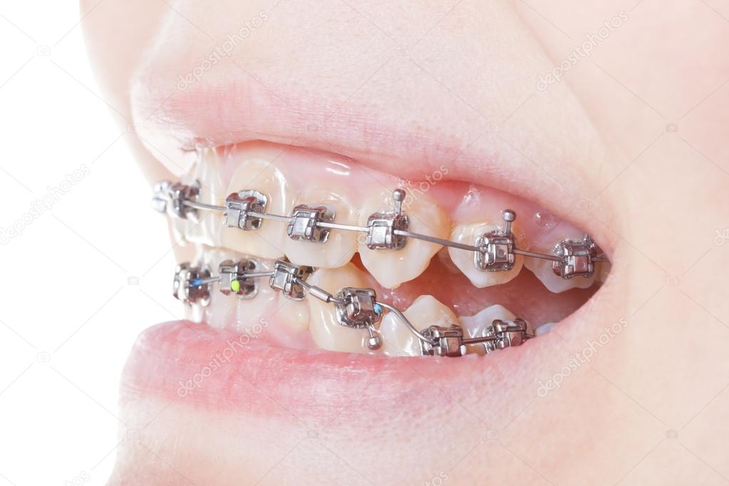 Teeth side view | Side view of dental braces on teeth close up — Stock ...