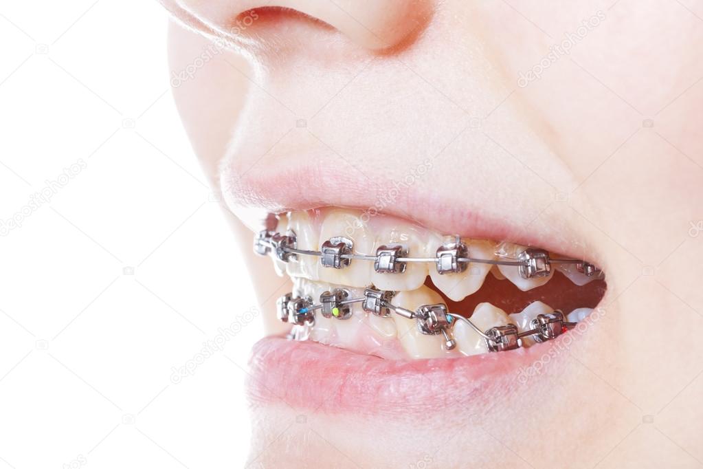 Dental steel braces on teeth close up — Stock Photo © vvoennyy #57968187
